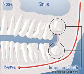 Wisdom Teeth Roots In Sinus